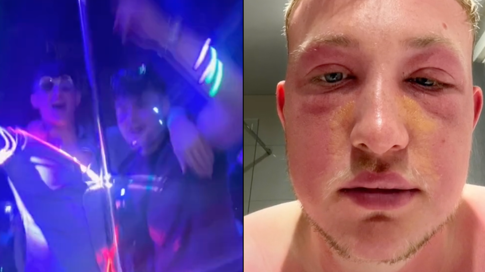 Lad Goes On Night Out On Holiday And Wakes Up Naked On Random Hotel