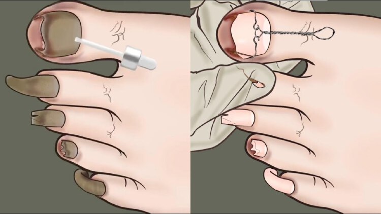 ASMR Ingrown Toenail Removal Treatment (Part 1) | Nestia