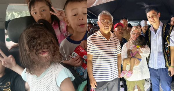 Raja Permaisuri Wants To "Adopt" Sarawakian Child With Rare Congenital ...