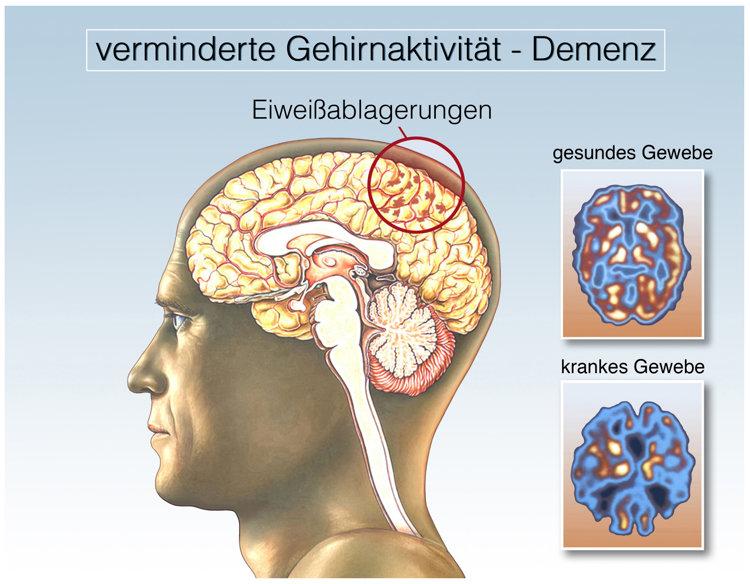 老年痴呆症的前兆，通常会说这些“口头禅”，对照下，看你中几条 | Nestia
