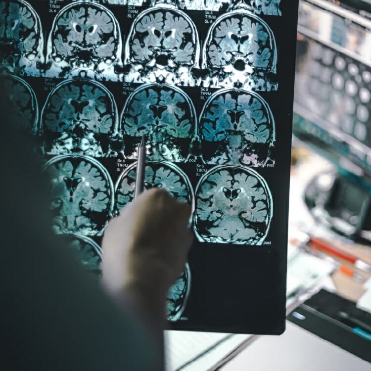 China joins US and Japan in approving Alzheimer’s drug Leqembi developed by Eisai and Biogen ...