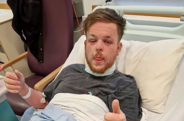 Man with UK's worst case of eczema was housebound and couldn't blink ...