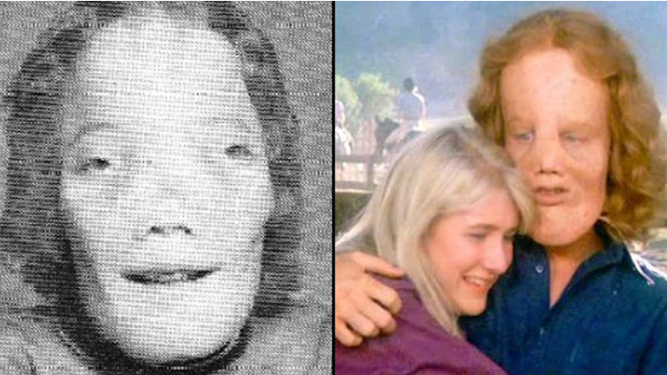 Tragic real life story of boy whose rare deformity inspired the famous ...