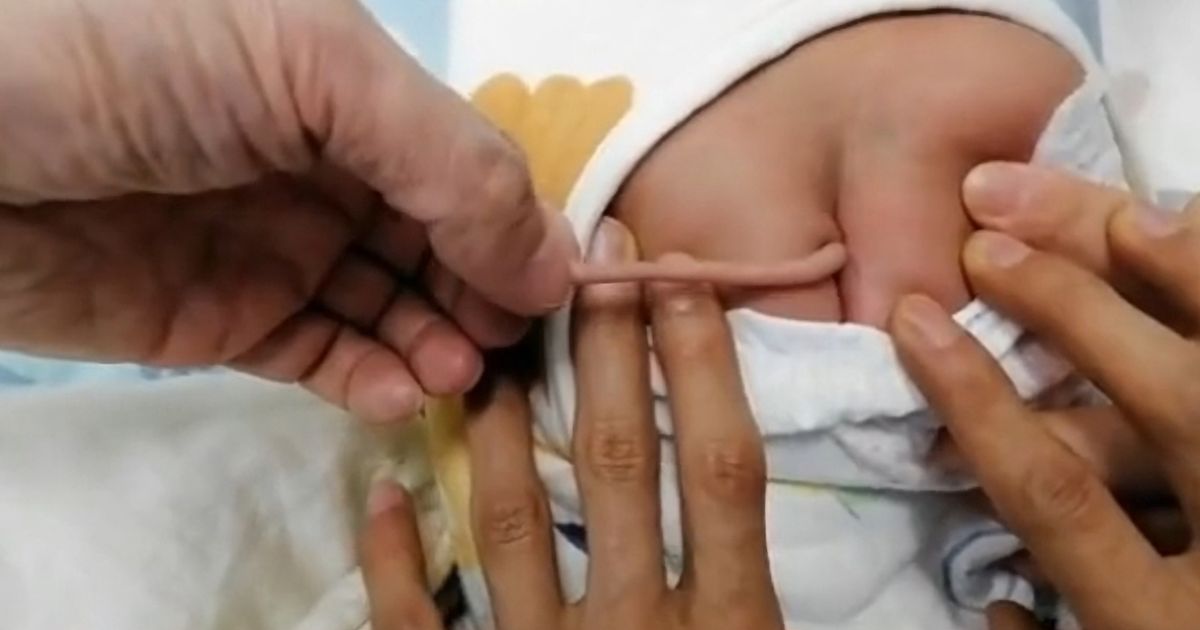 Baby born with four-inch tail growing from its back due to ultra rare ...