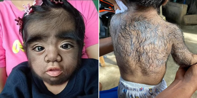 Mother in Philippines believes son has ‘werewolf syndrome’ because she ...