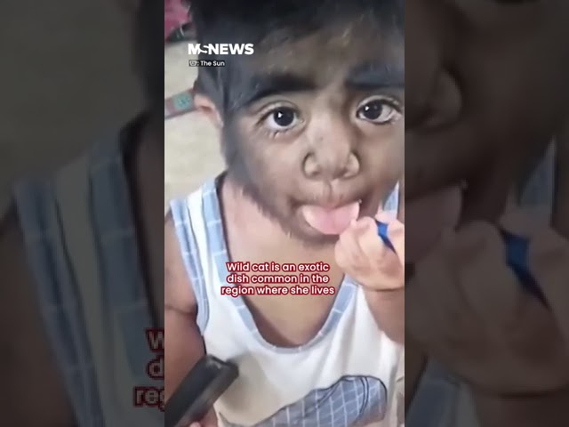 Boy in the Philippines suffers from "werewolf syndrome" | Nestia