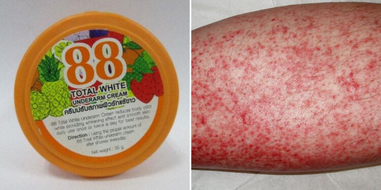 Woman suffers severe rash and liver damage after using product bought ...