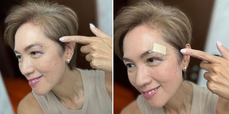 Minister Josephine Teo suffers 1-inch gash near eye after she... | Nestia